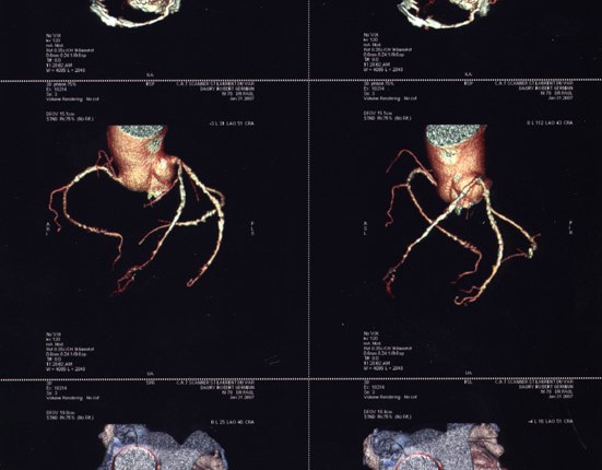 Le Coroscanner - Radiologie et Imagerie Médicale Tzanck
