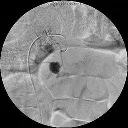 Embolisations artérielles et veineuses - Radiologie et Imagerie ...
